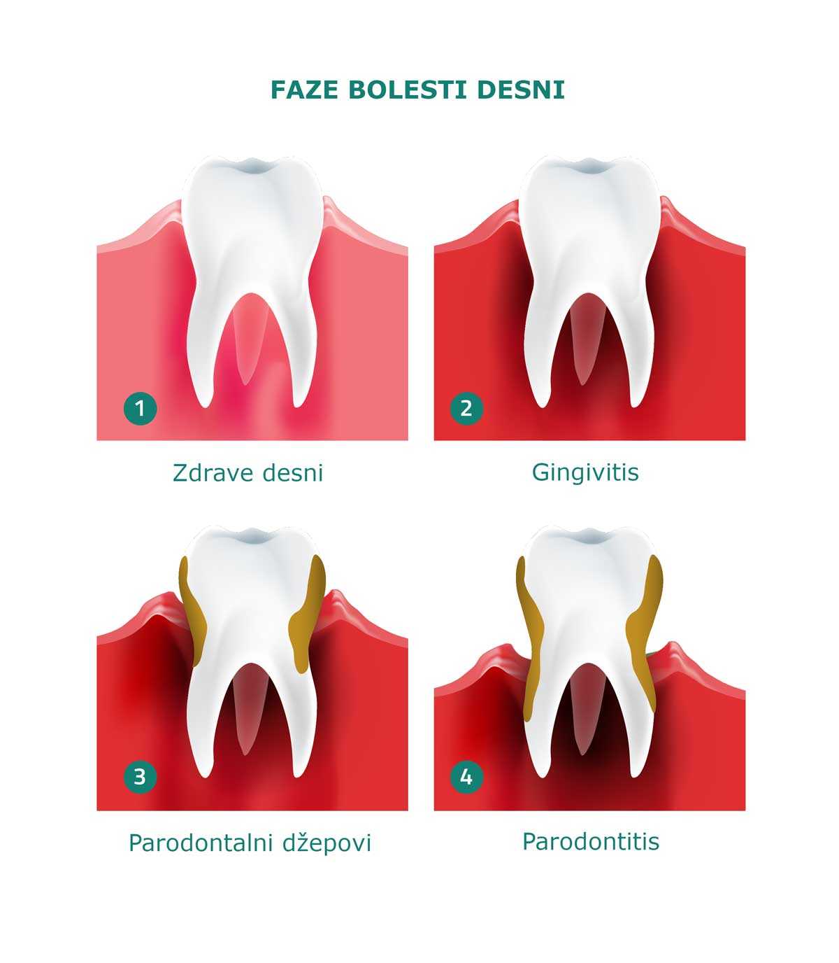 Parodontitis - Stomatološka poliklinika Apolonija