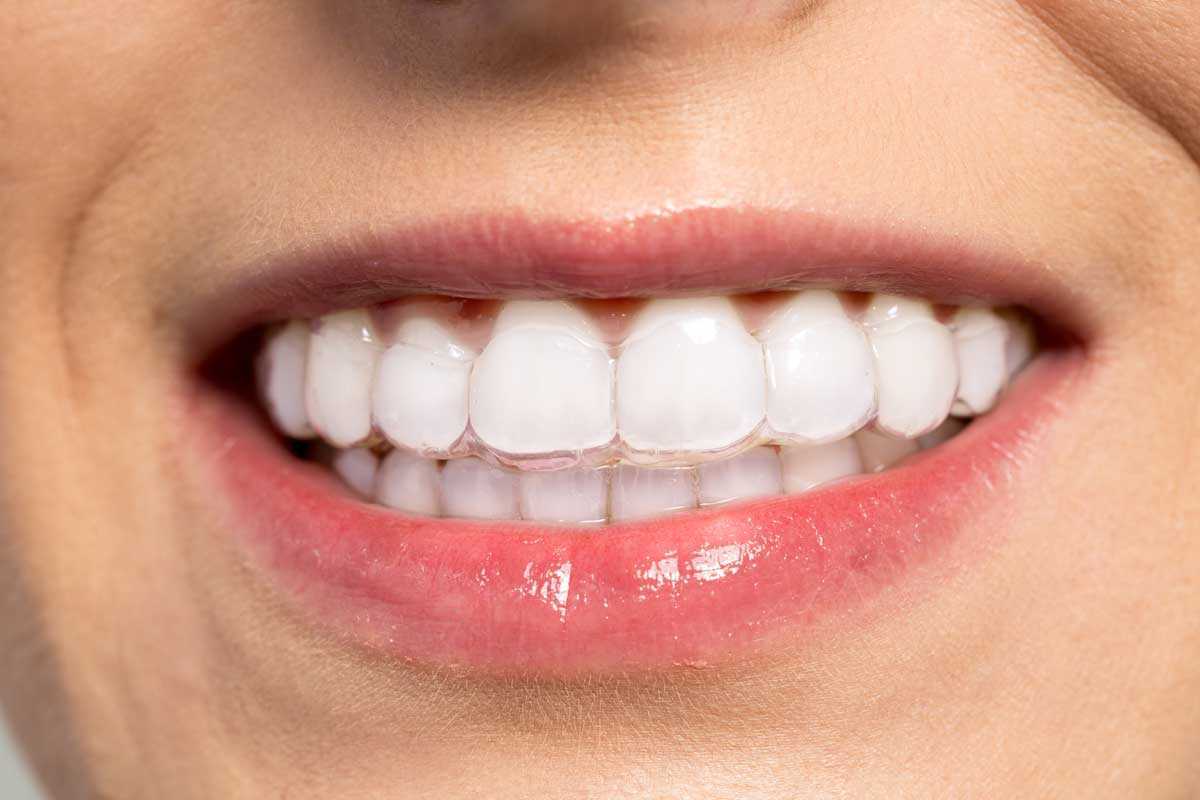 Invisalign - prozirni aparatić - Stomatološka poliklinika Apolonija